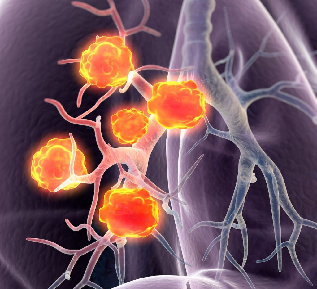 Investigational Radioenhancer Shows Feasibility in Stage III NSCLC ...
